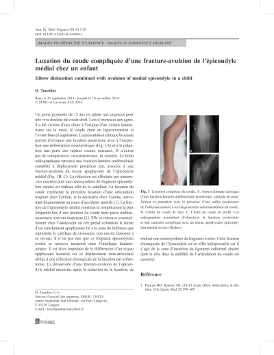 Luxation du coude compliquée d’une fracture-avulsion de l’épicondyle ...
